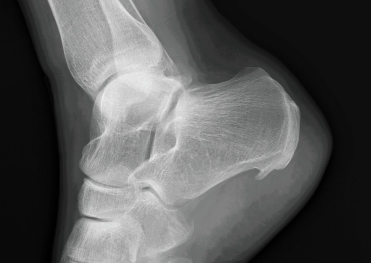 Leaders in Treating Heel Spurs | Advanced Ankle & Foot