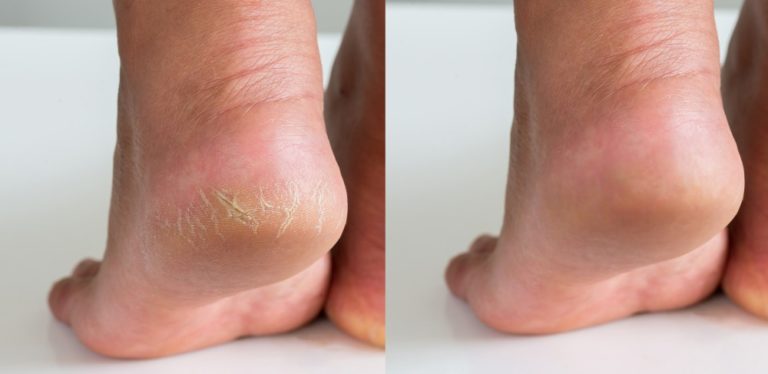 Why Do I have Dry Feet or Cracked Feet? | Advanced Ankle & Foot