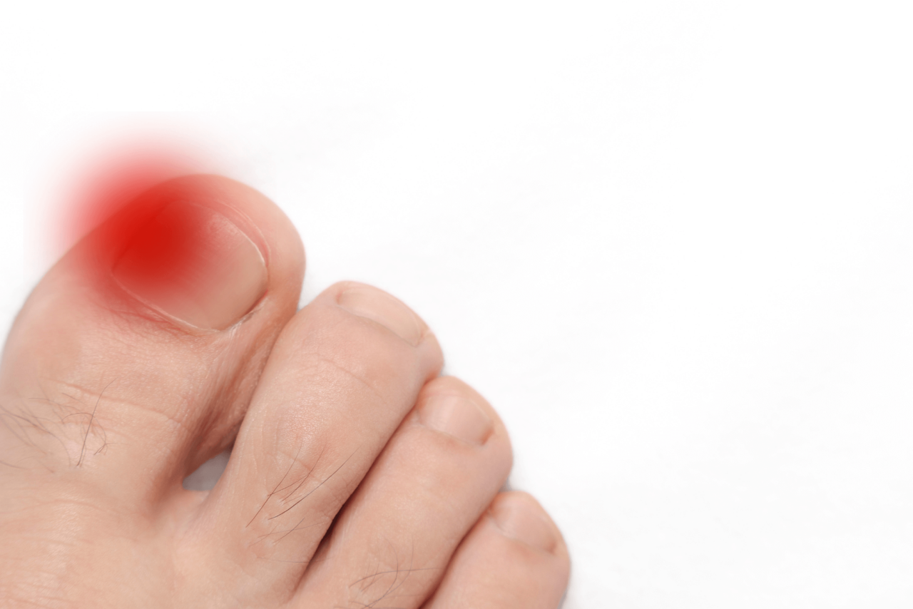 Ingrown Toenails Treatment In Arizona at Advanced Ankle & Foot